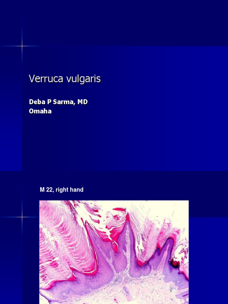 Verruca Vulgaris., M 22.,PPT | PDF | Epidermis | Glands