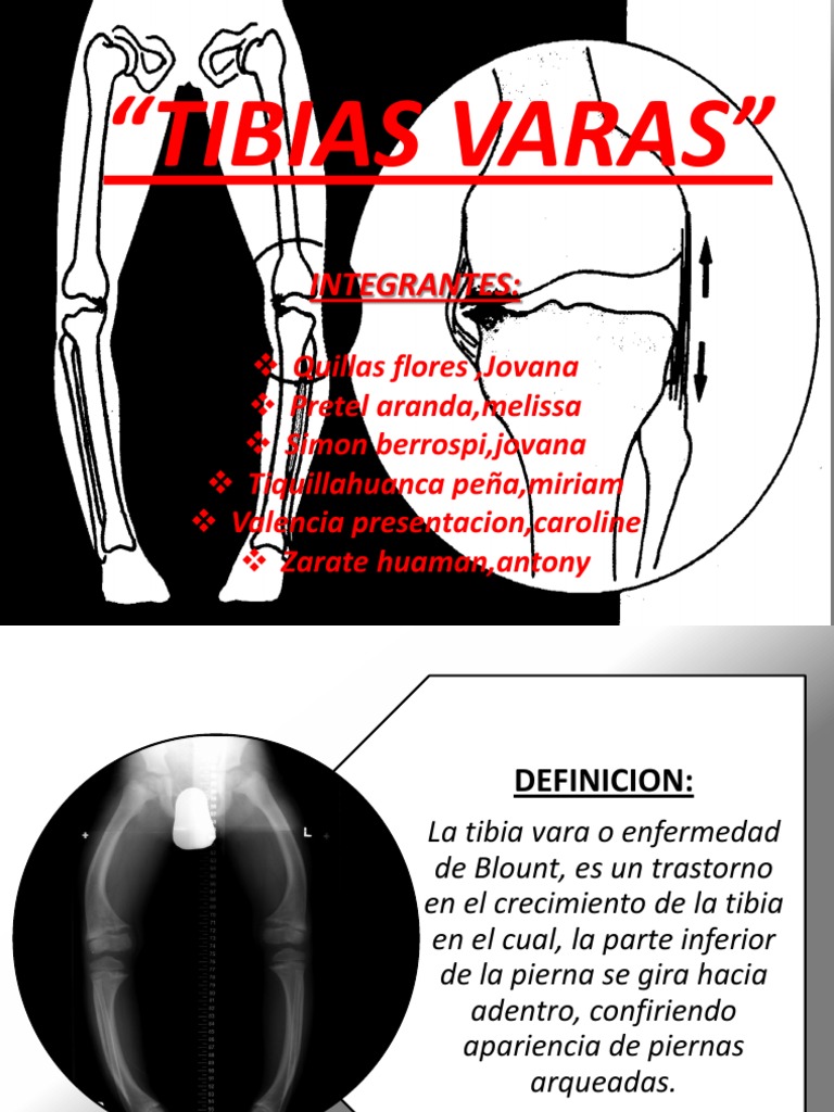Tratamiento de Tibia Vara | PDF | Rodilla | Pie