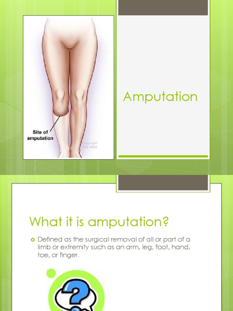 Amputation | Download Free PDF | Amputation | Prosthesis