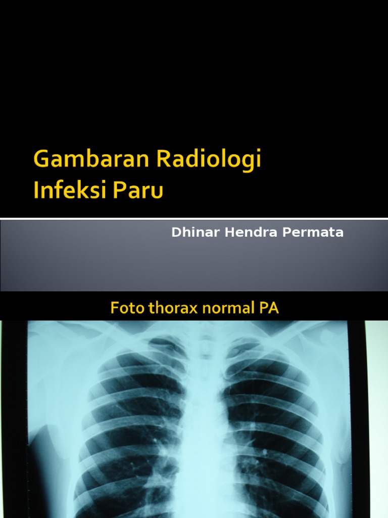 Radiologi Infeksi Paru | PDF