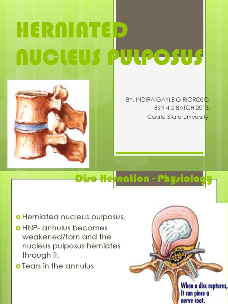 Herniated Nucleus Pulposus | PDF | Animal Anatomy | Musculoskeletal System