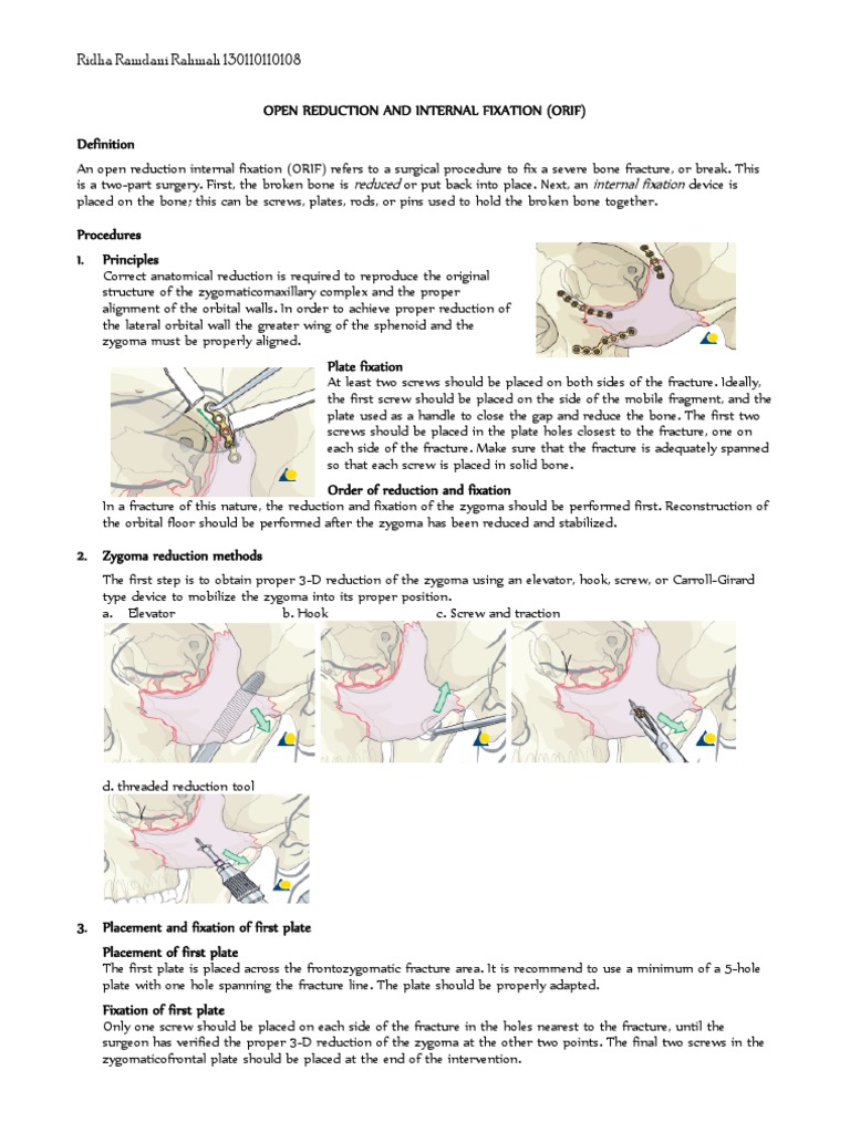 ORIF Procedure for Zygomatic Fractures | PDF | Screw | Surgery