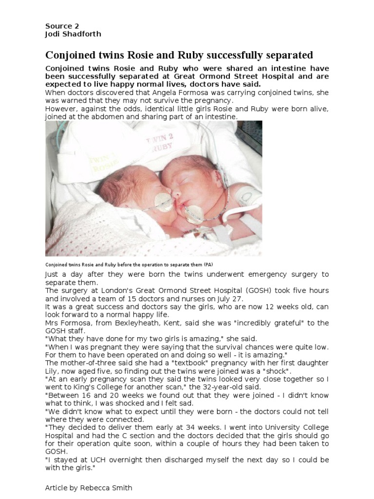 Conjoined Twins Article | Conjoined Twins | Twin