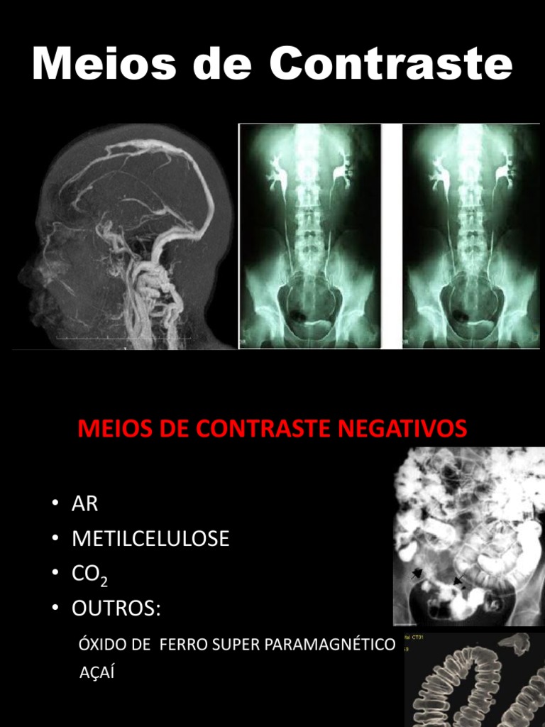 Tipos de Meios de Contraste Radiológicos | PDF | Alergia | Radiologia
