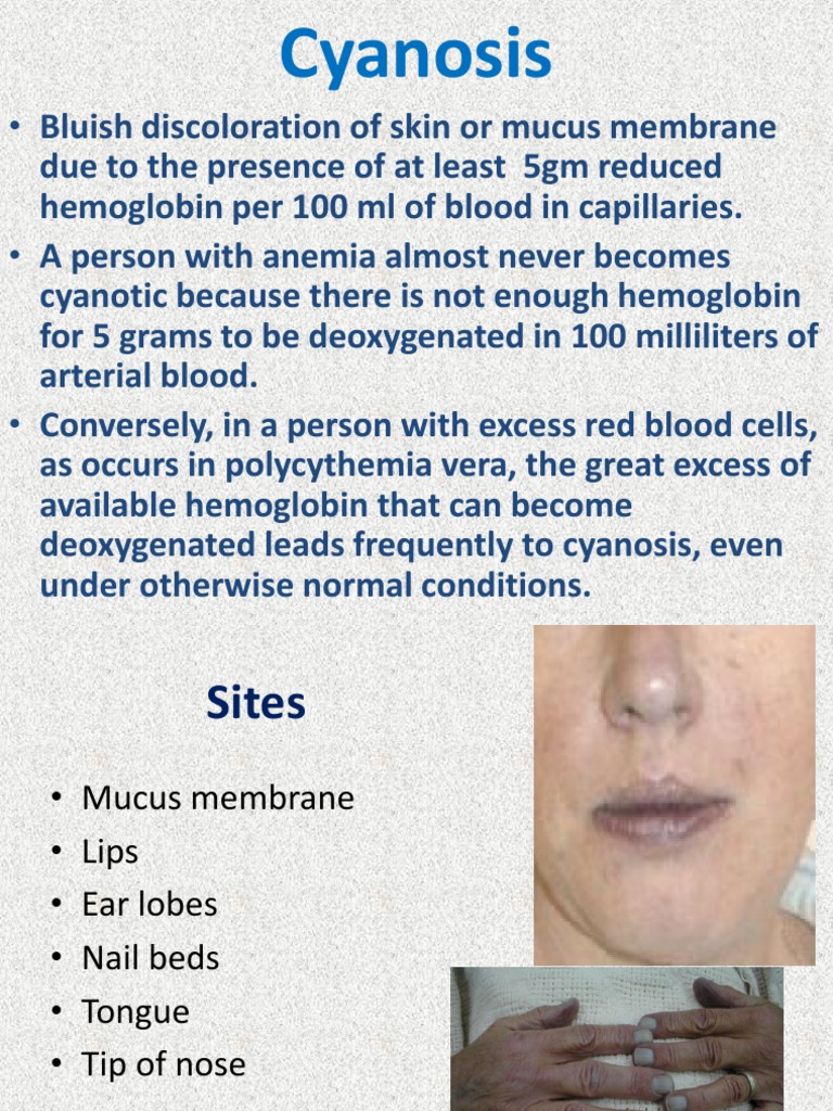 Cyanosis | PDF | Hypoxia (Medical) | Respiratory System