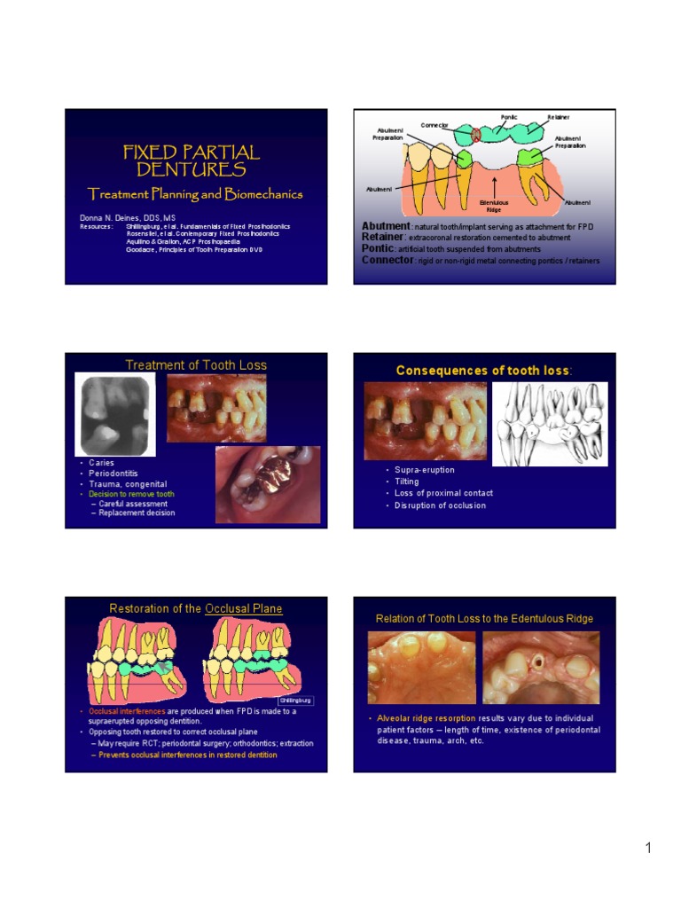 1 FP2 FPD Lecture 2011pdf | PDF | Dental Implant | Dentures