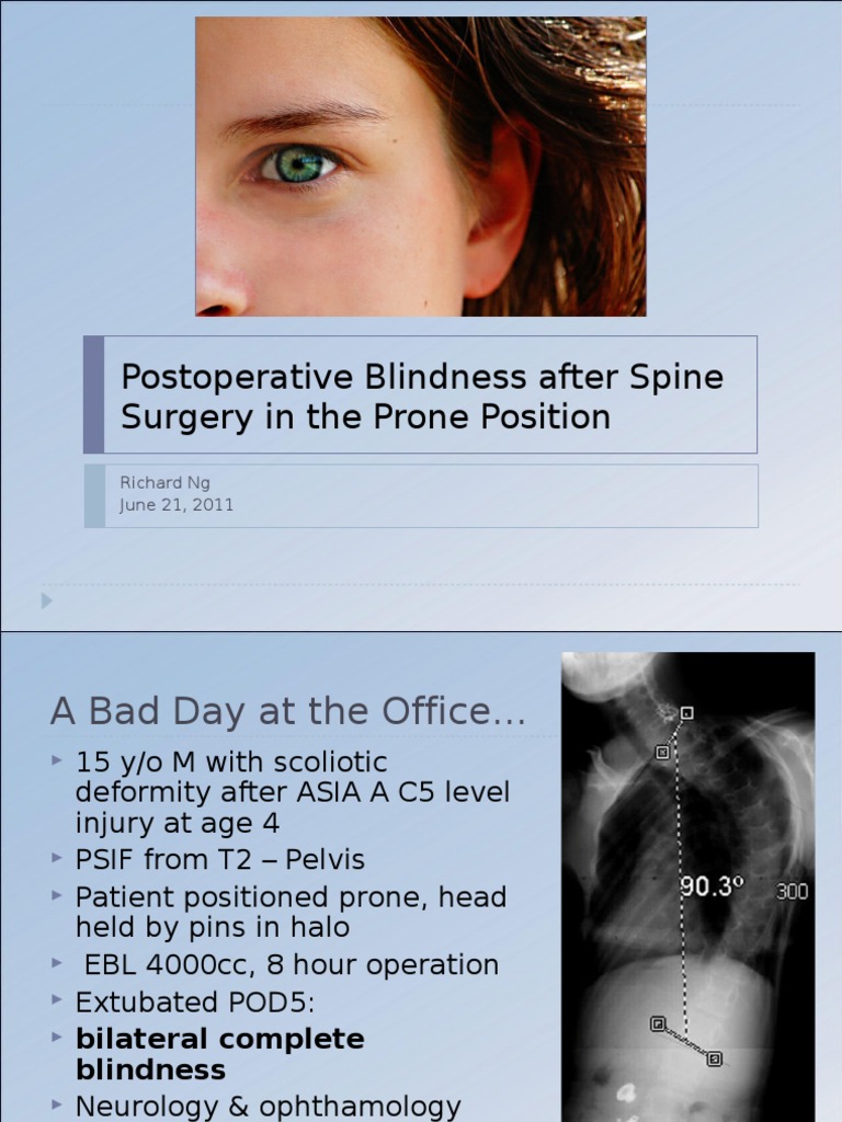 Postoperative Blindness After Spine Surgery in The Prone Position | PDF ...