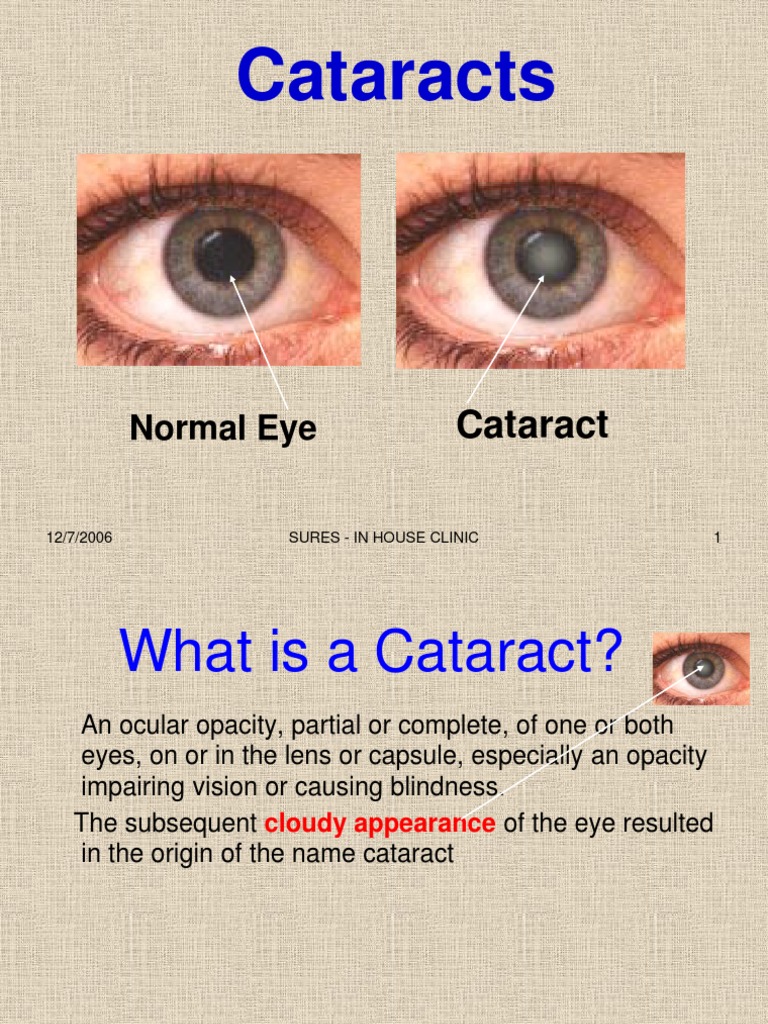 Types and Management of Cataracts | PDF | Cataract | Ophthalmology
