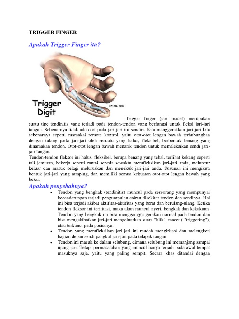 Trigger Finger | PDF