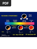 Ecg Interpretation J Point Stemi Criteria Equivalents and Others | PDF ...