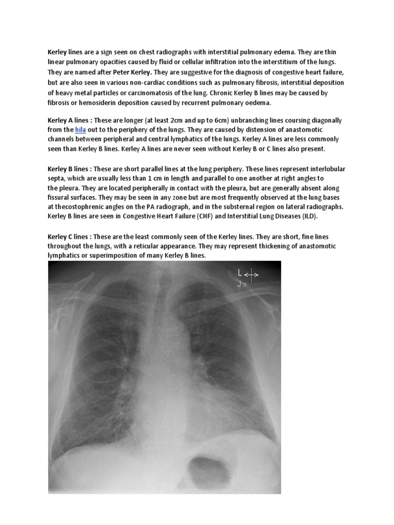 Kerley's Line | Lung | Vein