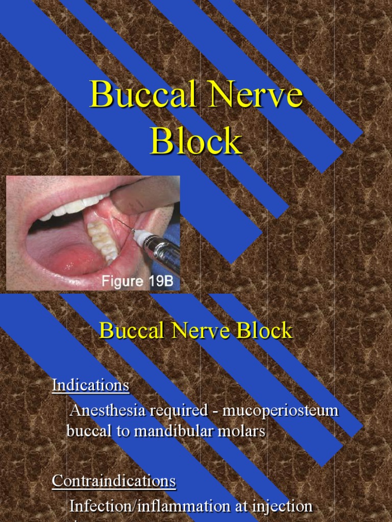 Buccal Nerve Block | PDF