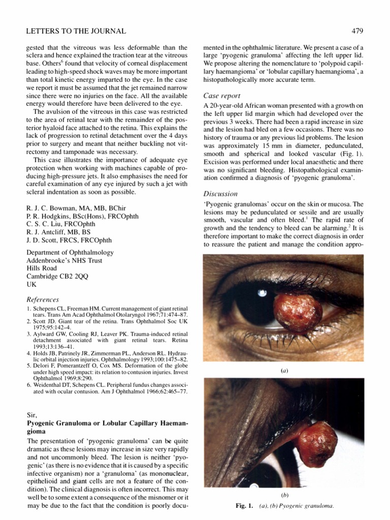 Granuloma Piogenik | PDF | Medical Specialties | Ophthalmology