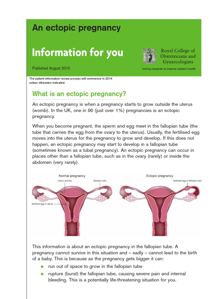 Information For You: An Ectopic Pregnancy | PDF