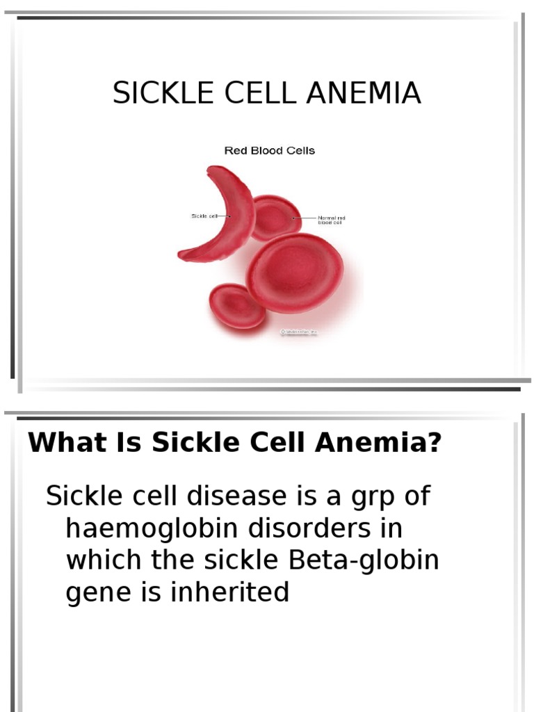 Sickle Cell Anemia | Anemia | Tissue (Biology)