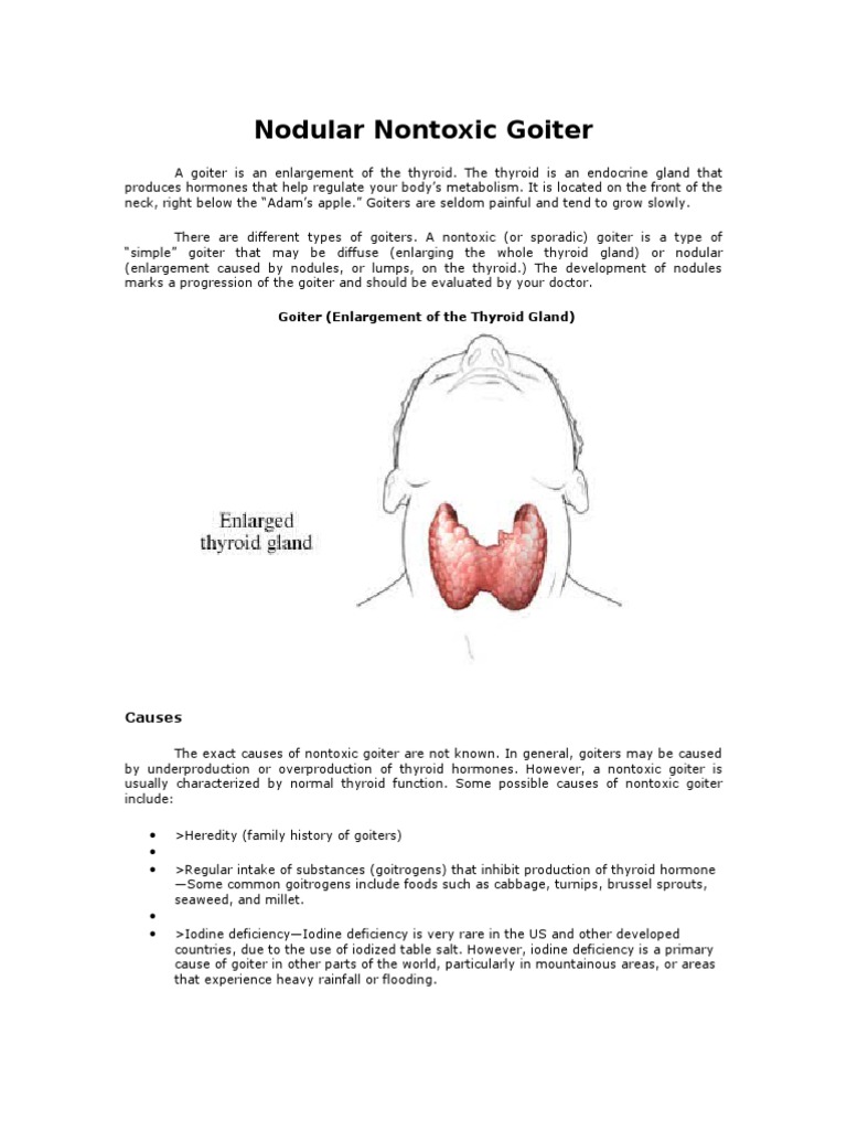 nodular nontoxic goiter.doc | Thyroid | Endocrine System