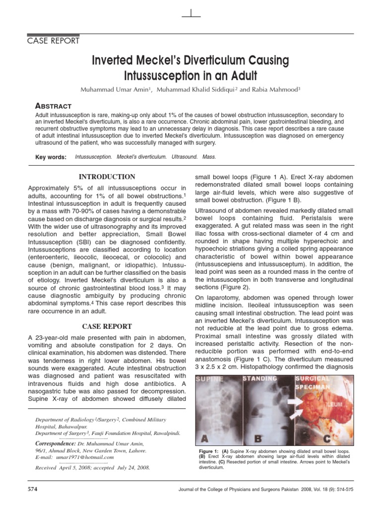 Inverted Meckel's Diverticulum Causing Intussusception in An Adult ...