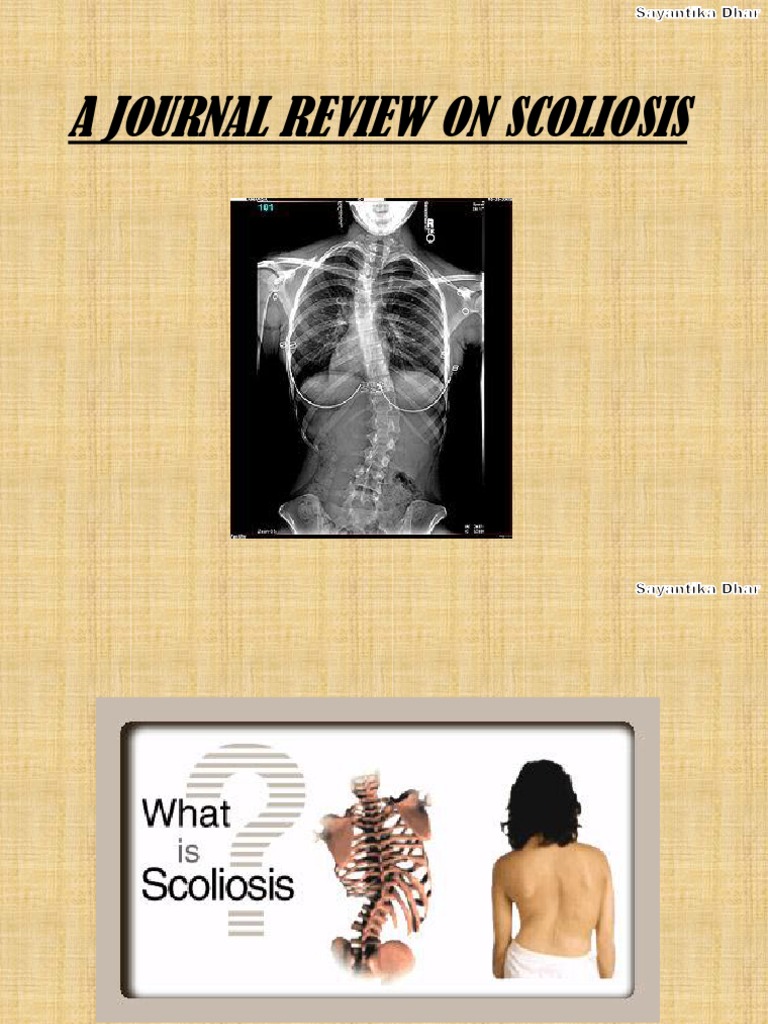 Scoliosis | Scoliosis | Vertebral Column
