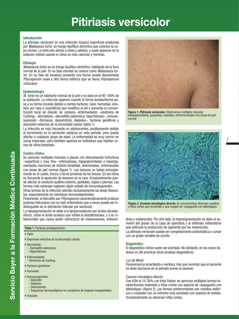 Tiña Versicolor | Descargar gratis PDF | Medicina CLINICA ...