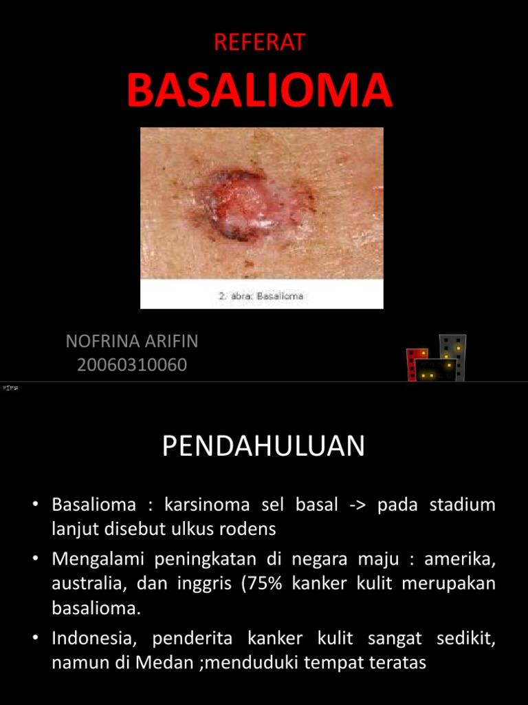 Basalioma | PDF