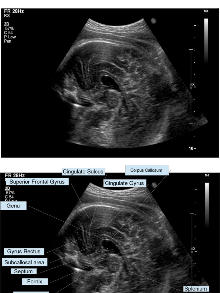 Brain Ultrasound | PDF