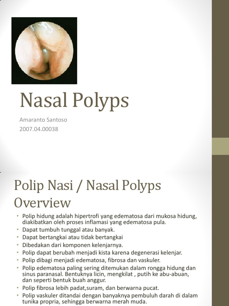 Nasal Polyps | PDF