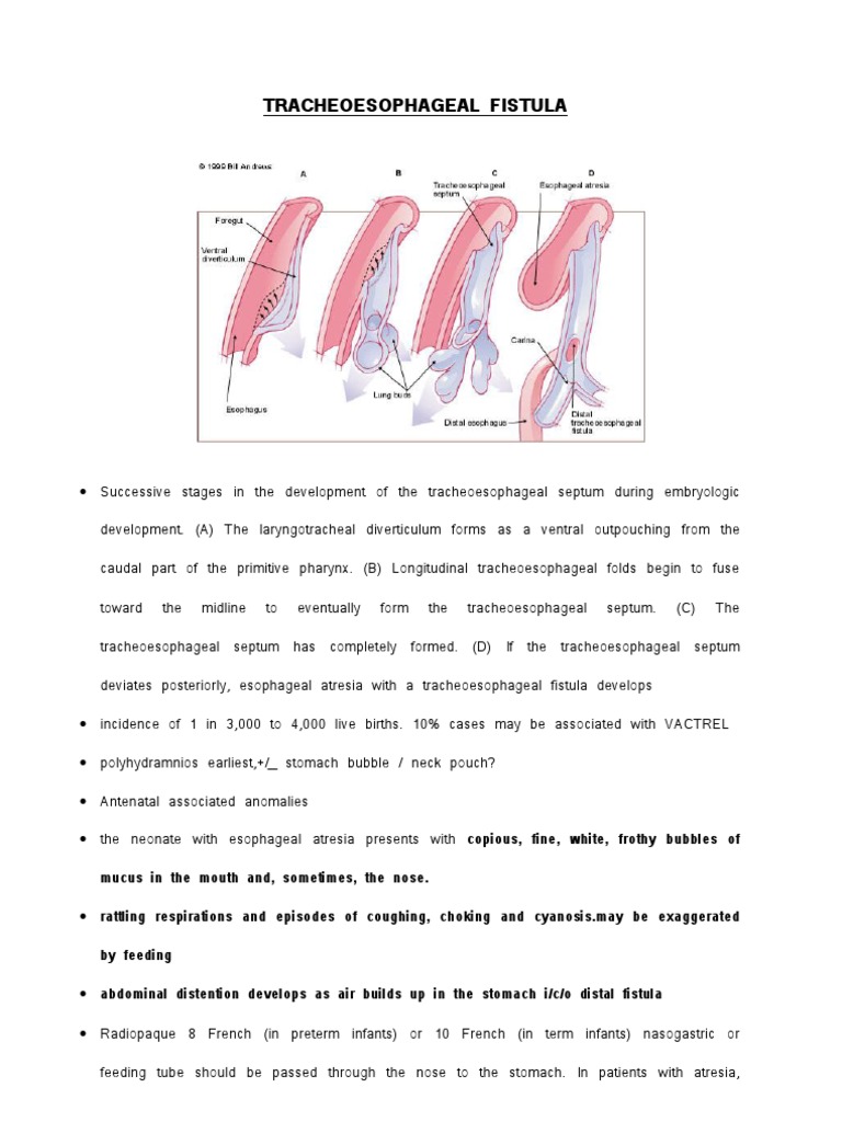 Tracheoesophageal Fistula | PDF | Esophagus | Gastroesophageal Reflux ...