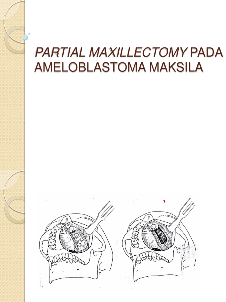 Partial Maxillectomy Pada Ameloblastoma Maksila | PDF