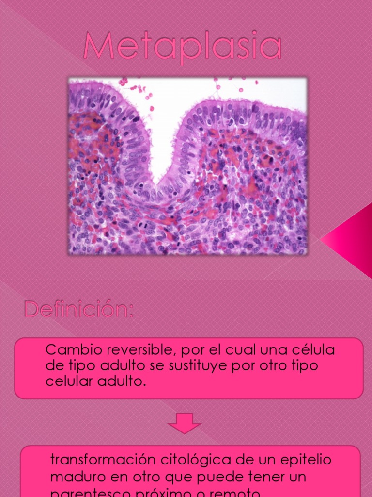 Metaplasia | PDF