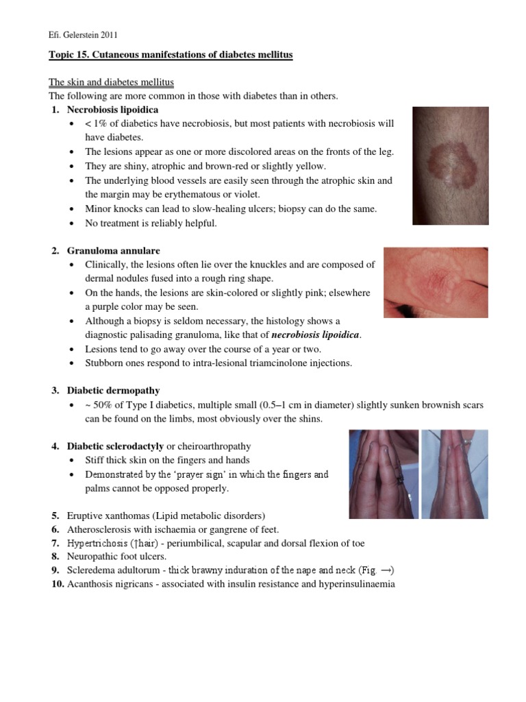Skin Conditions Linked to Diabetes Mellitus | PDF | Cutaneous ...