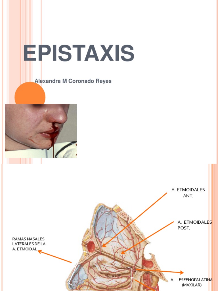 Epistaxis | PDF | Medicina | Enfermedades y trastornos