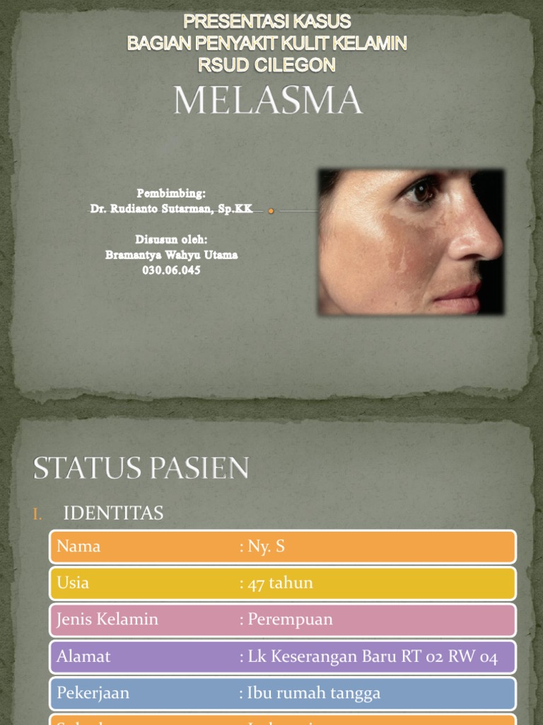 Case Melasma | PDF