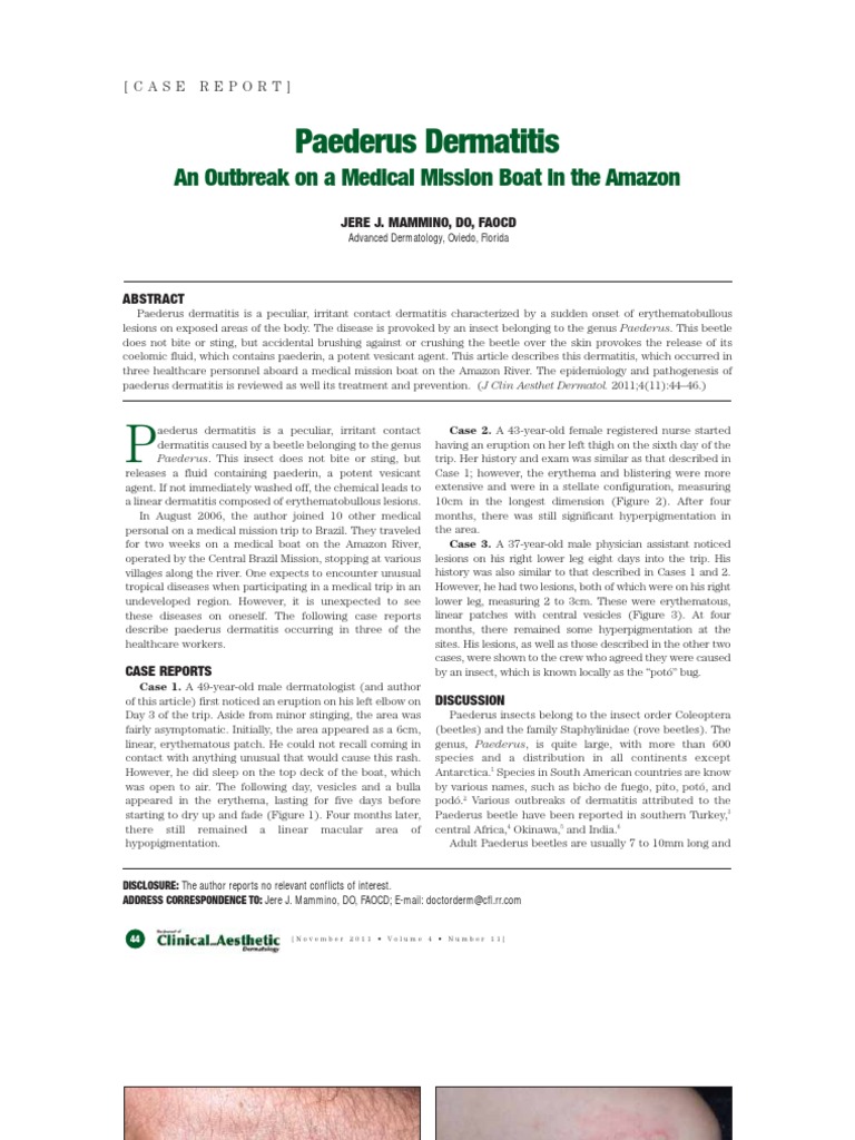 Paederus Dermatitis an Outbreak on a Medical Mission Amazon | Medicine ...