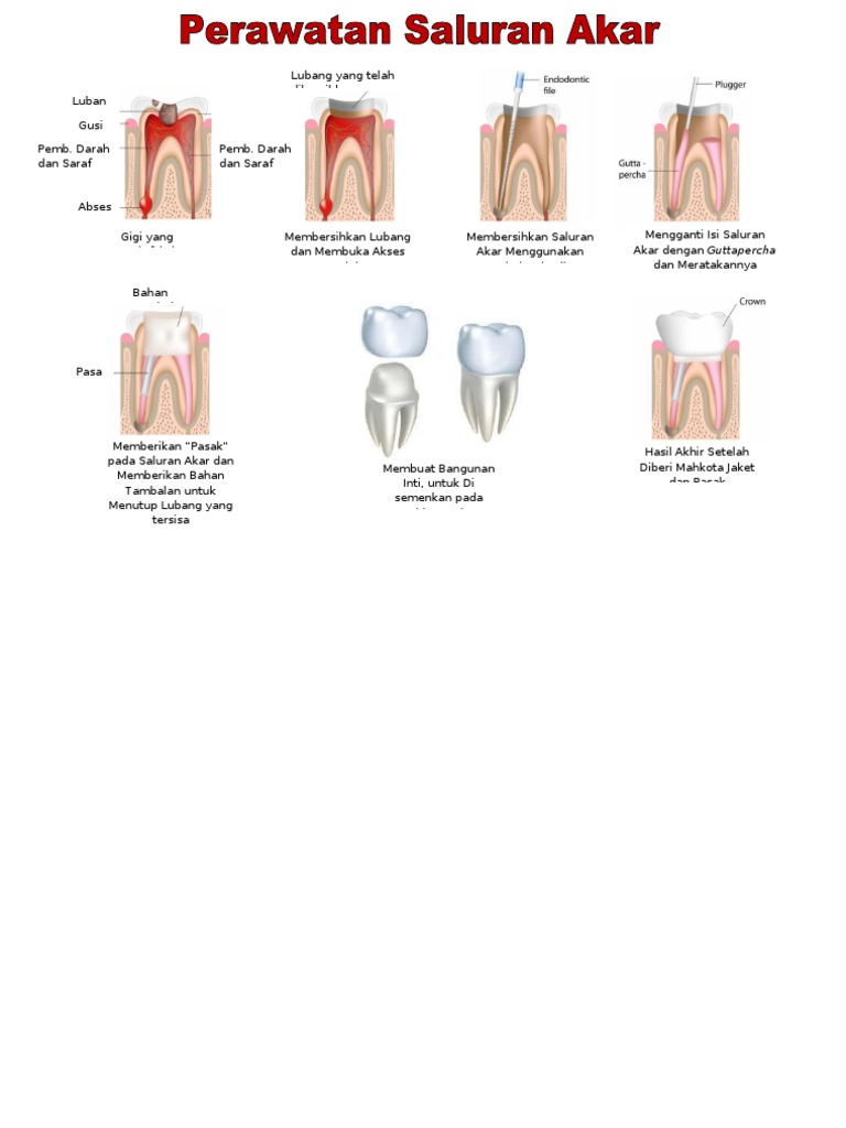Tahapan Perawatan Saluran Akar | PDF