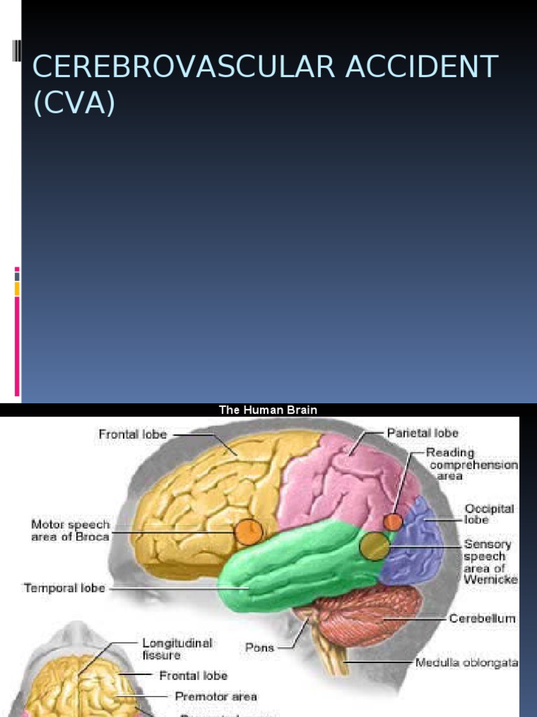 Cerebrovascular Accident | Stroke | Ischemia