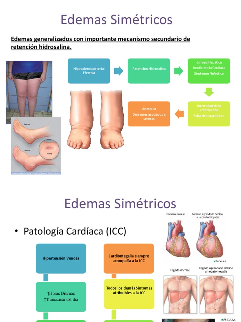 Edemas Simétricos | Edema | Cirrosis