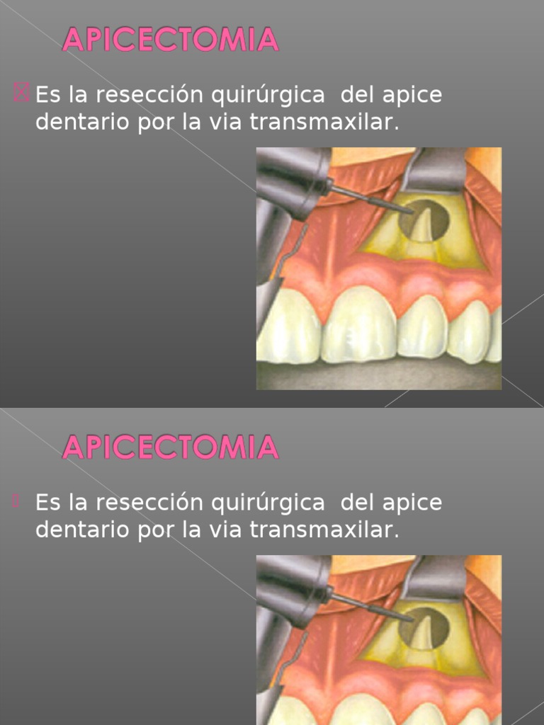 Apicectomia | PDF | Odontología | Boca