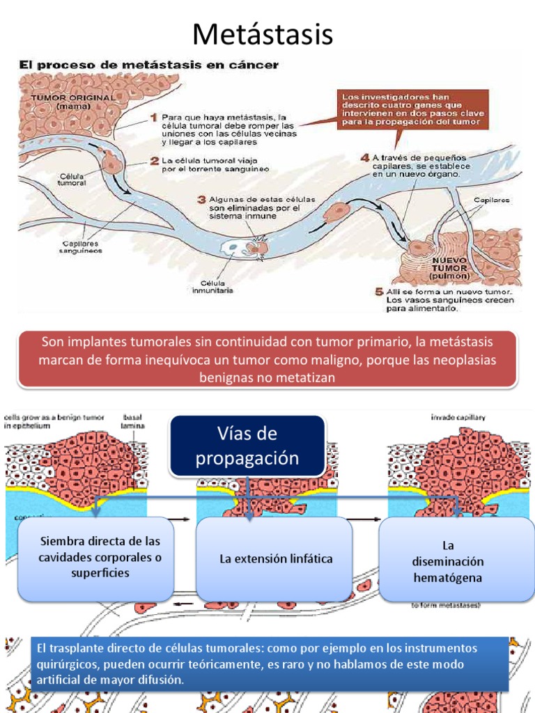 Metástasis y Diseminación del Cáncer | PDF | Metástasis | Cáncer
