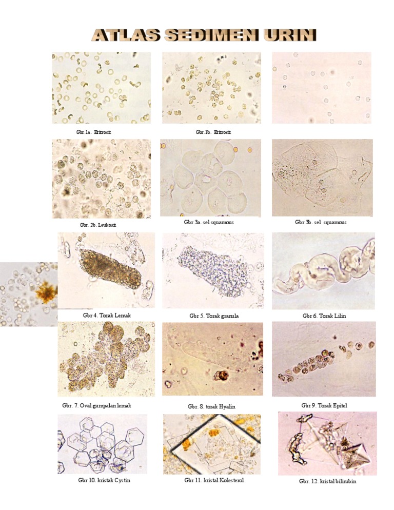 SEDIMEN URIN BMD | PDF