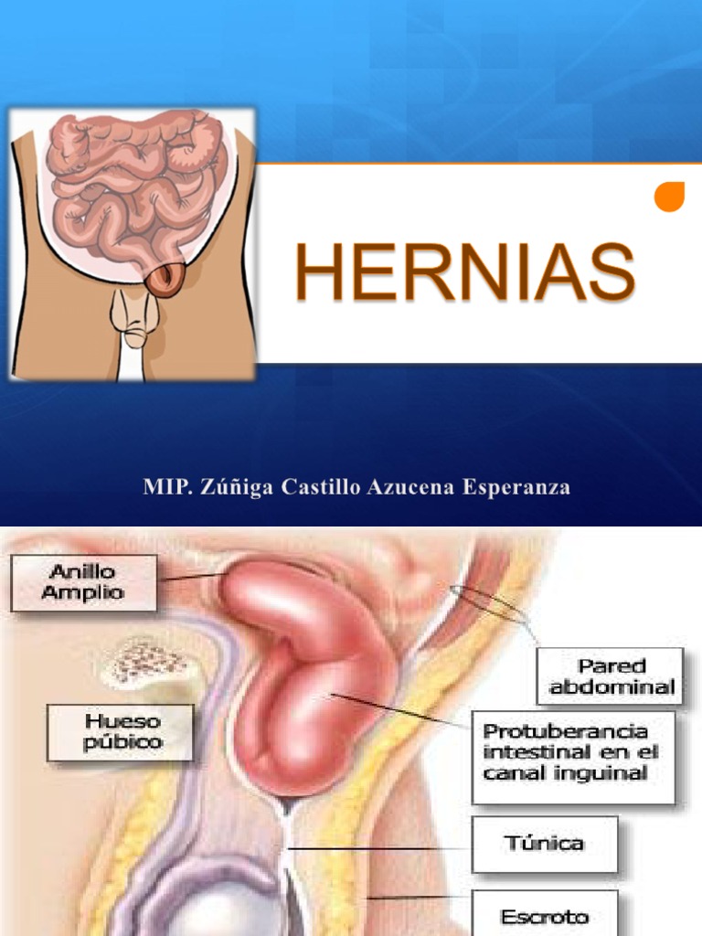 HERNIAS | PDF | Abdomen | Músculo