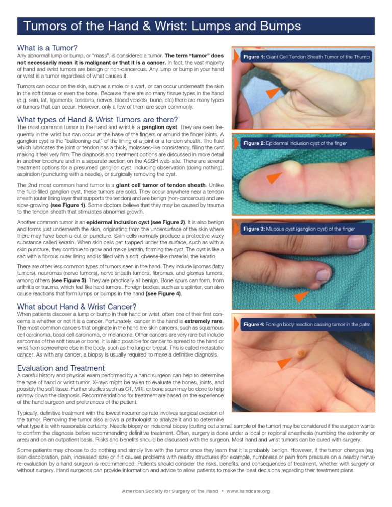 Tumors of the Hand & Wrist: Lumps and Bumps Guide | PDF | Biopsy ...
