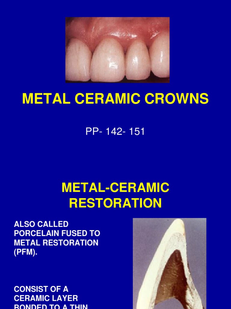 Metal Ceramic Restoration | PDF | Dentistry Branches | Mouth