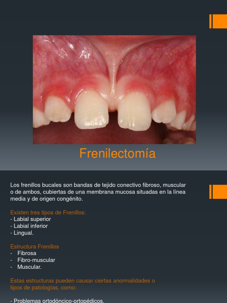 FRENILECTOMIA | PDF | Anatomía humana | Boca