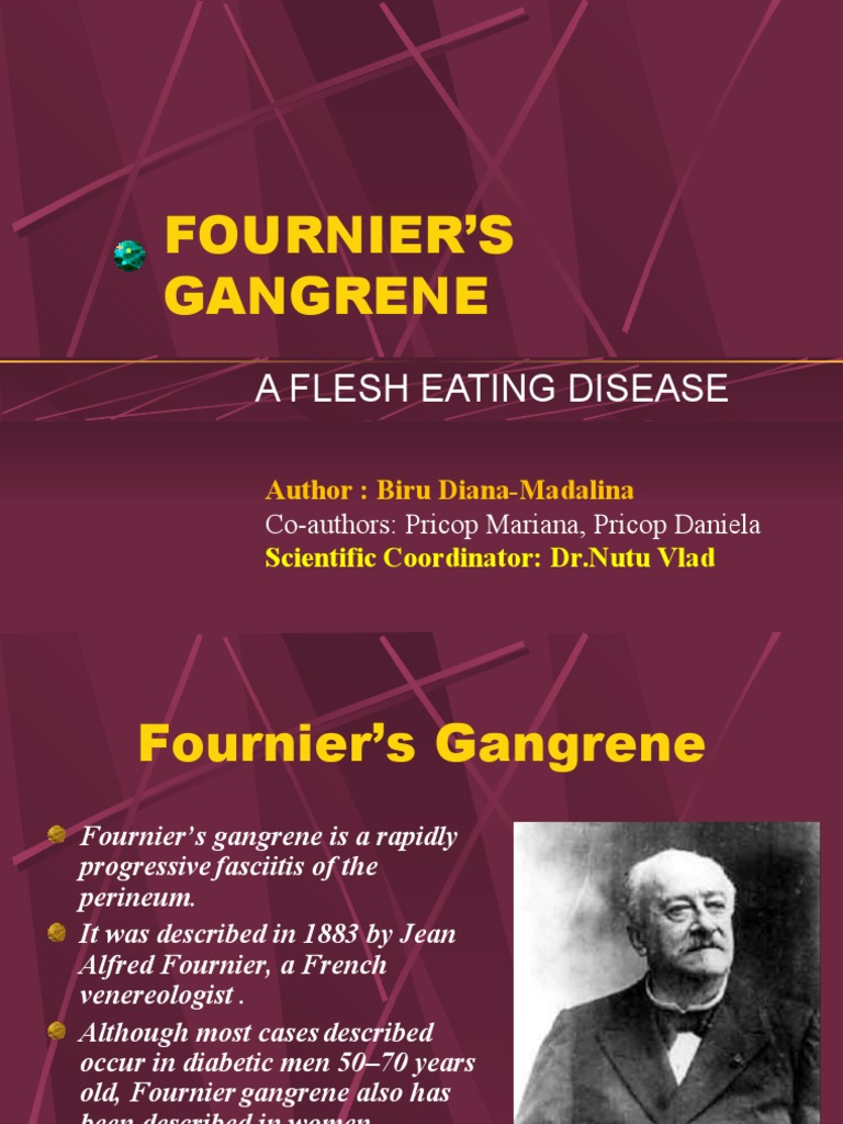 Fournier Gangrene-A Flesh Eating Disease | Wound | Thrombosis