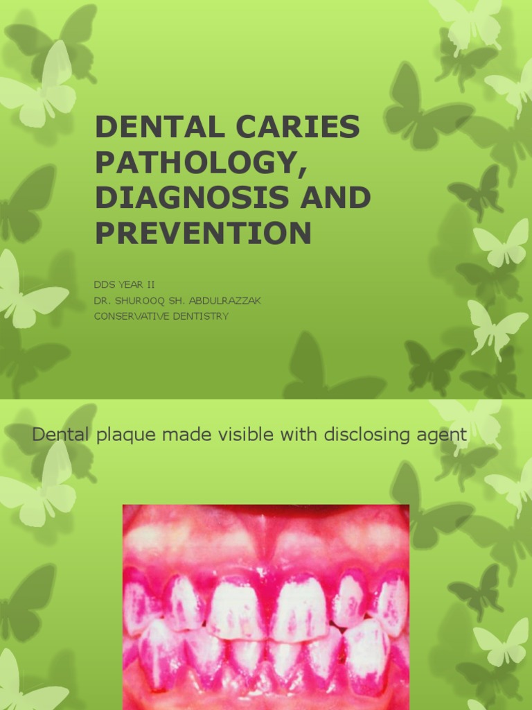 Dental Caries Pathology, Diagnosis and Prevention | Human Tooth | Tooth ...