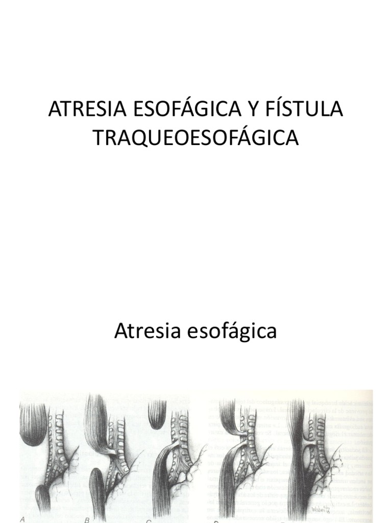 Atresia Esofágica y Fístula Traqueoesofágica | PDF