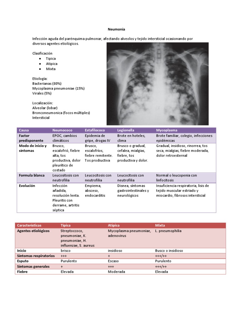 Neumonía RX | Neumonía | Pulmón