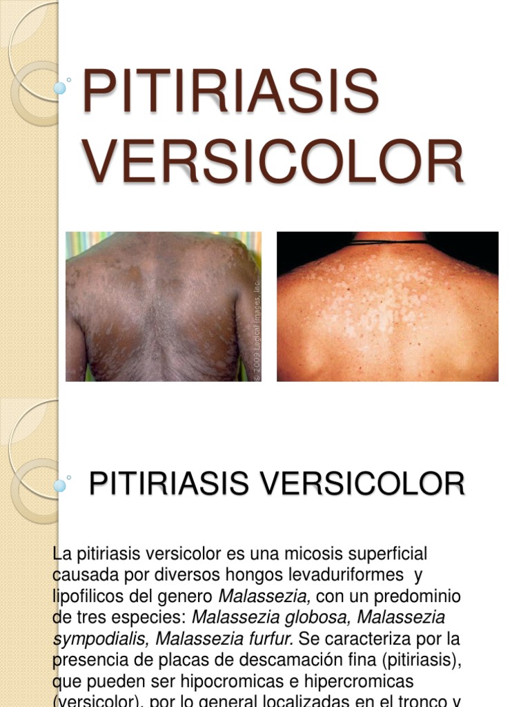 PITIRIASIS VERSICOLOR Diapos Con Imagenes Micologia | Especialidades ...