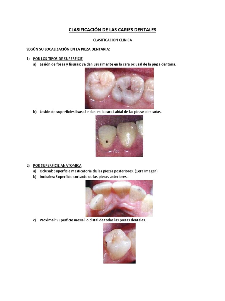 Clasificación de Las Caries Dentales | PDF | Diente humano | Boca