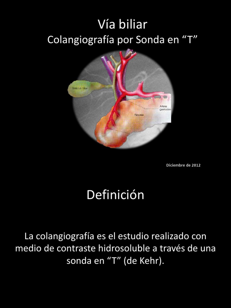 Colangio Por T | Vesícula biliar | Hígado